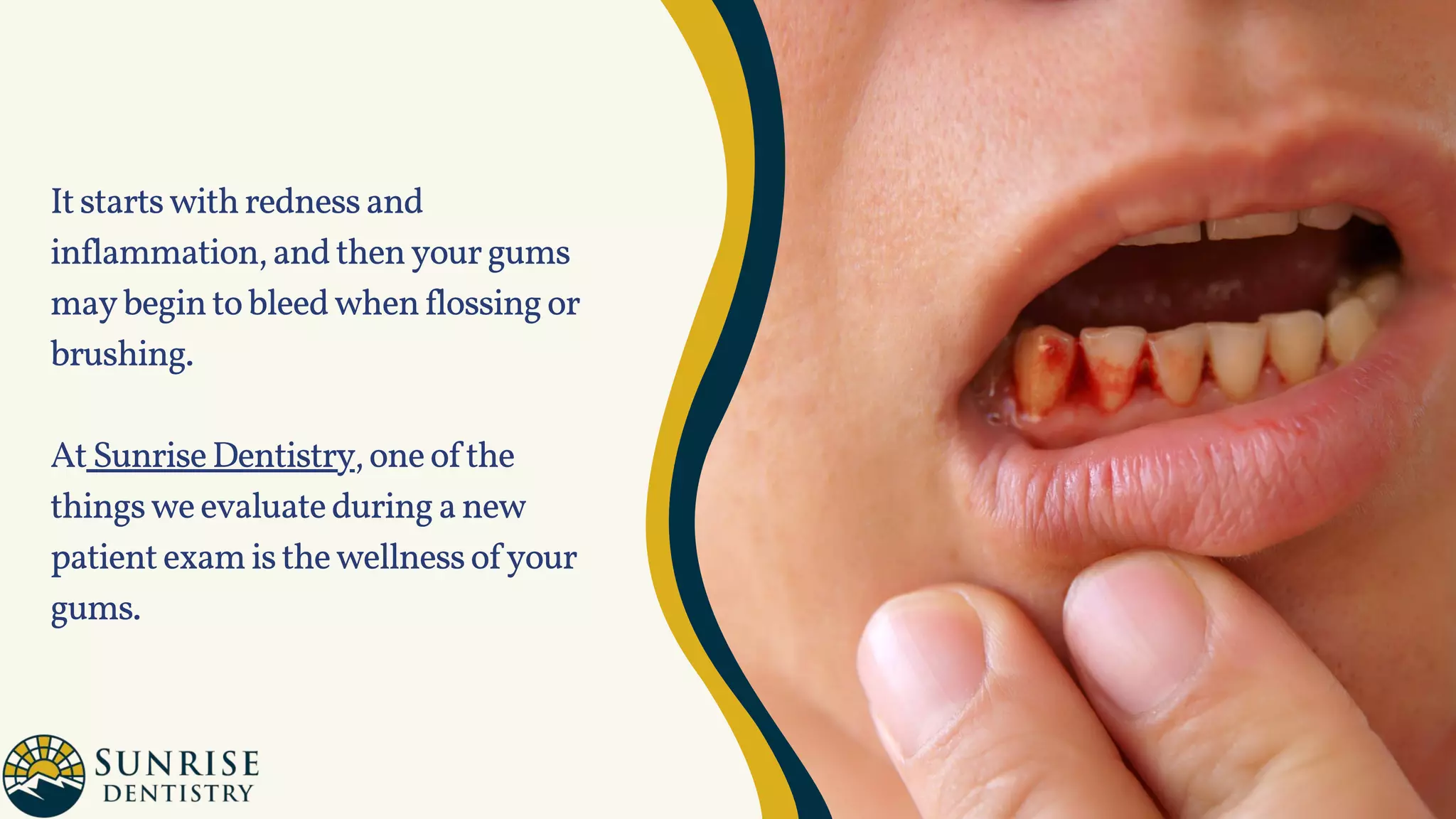 What is Happening with My Gums? Gum Disease, Bleeding, and Causes and ...