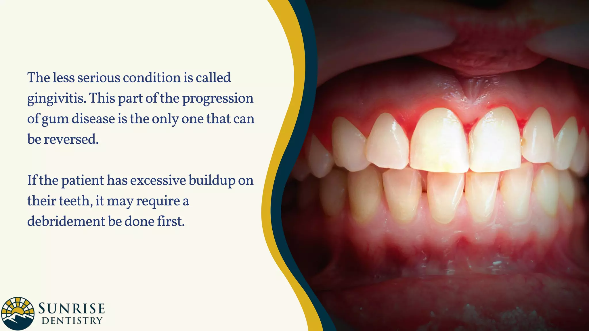 What is Happening with My Gums? Gum Disease, Bleeding, and Causes and ...