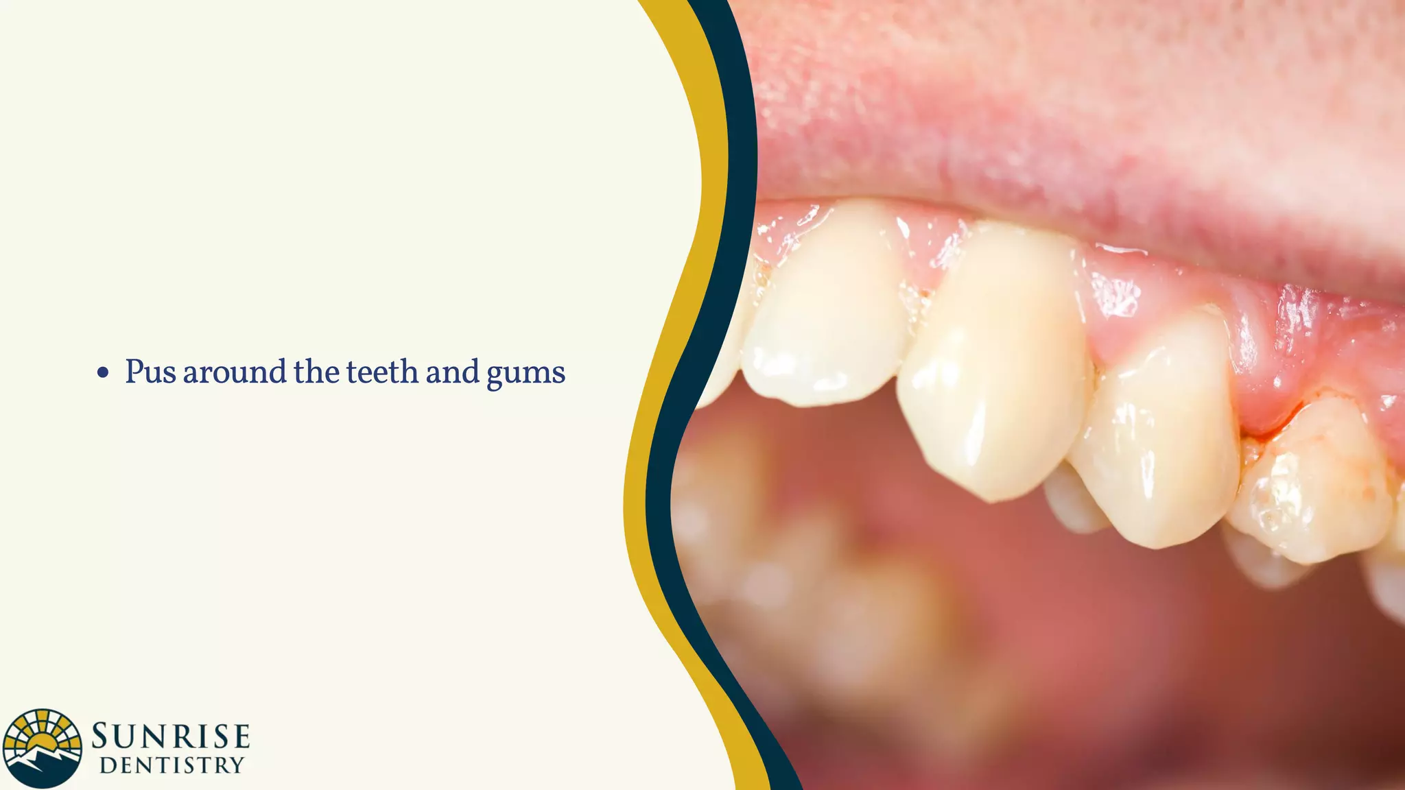 What is Happening with My Gums? Gum Disease, Bleeding, and Causes and ...