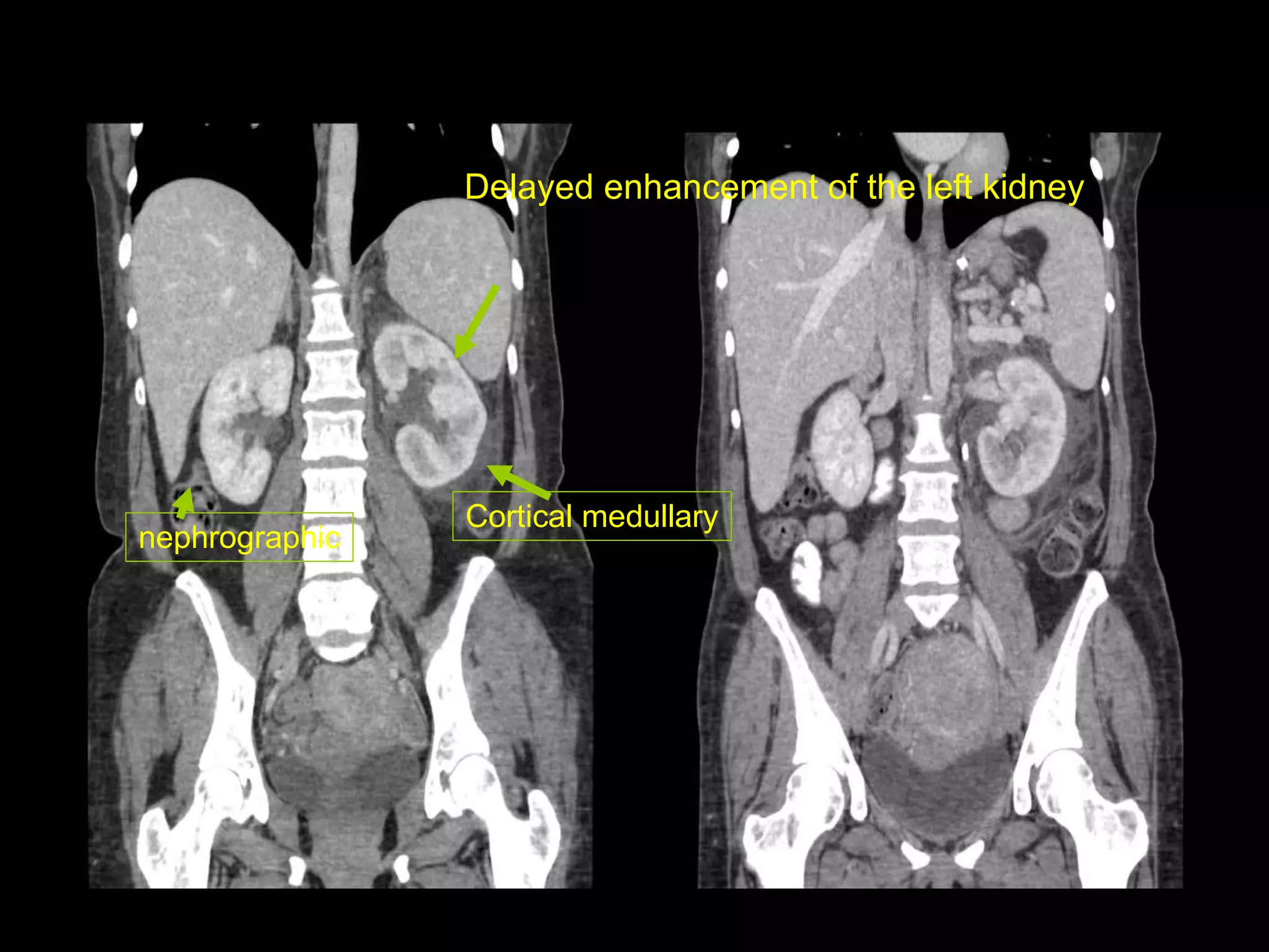 Radiology Rounds: 40 year old female with left flank pain | PPT