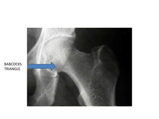 Tuberculosis of the hip | PPTX