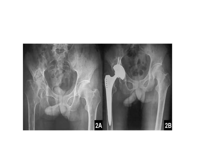 Tuberculosis of the hip | PPTX