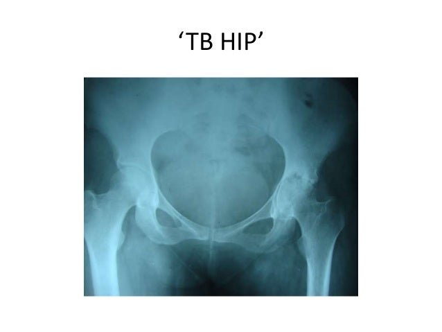 Tuberculosis of the hip