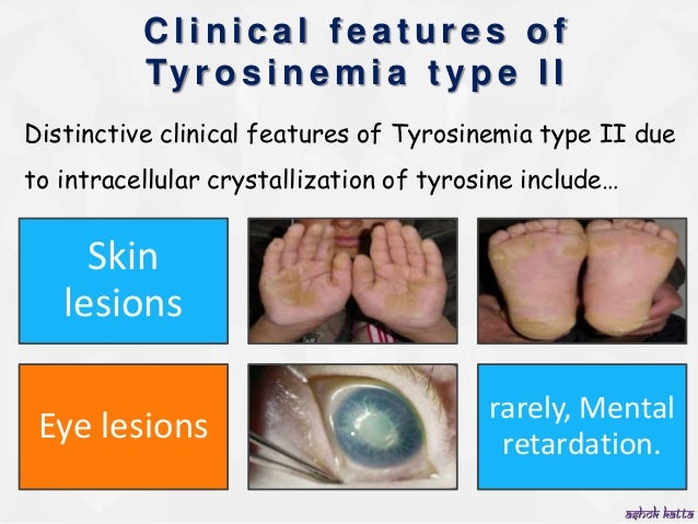 Metabolic Disorders of Phenylalanine and Tyrosine