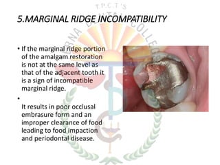 41.-amalgam-failures in restorative dentistry | PDF