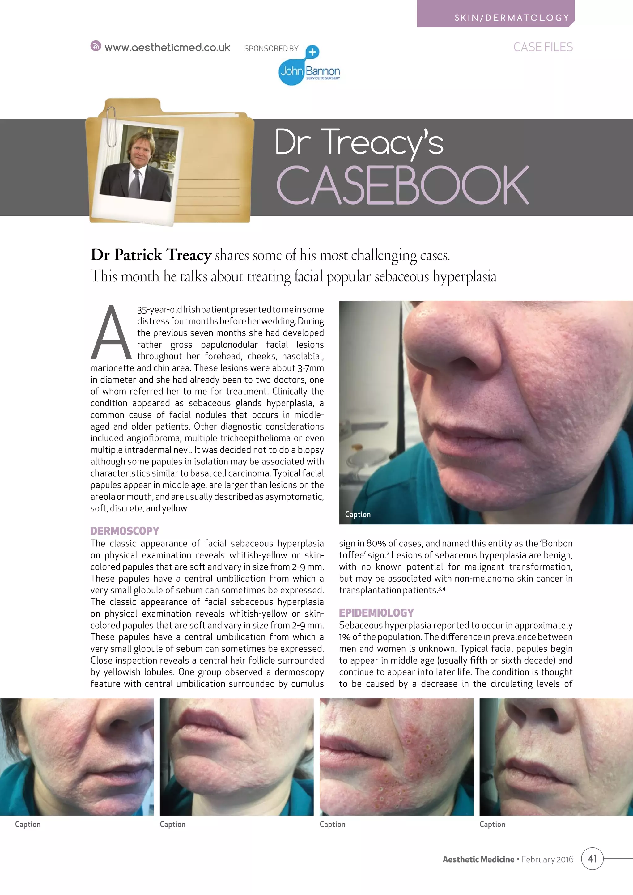 Dr Treacy’s treating facial popular sebaceous hyperplasia | PDF