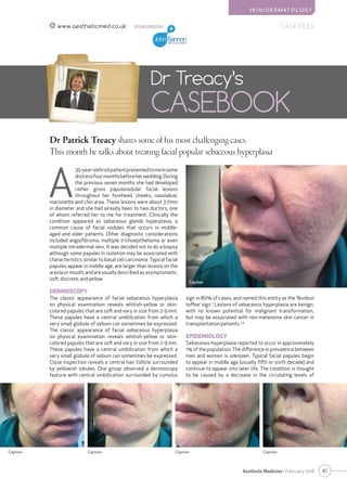 Dr Treacy’s treating facial popular sebaceous hyperplasia | PDF