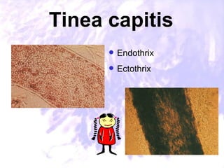 41. laboratory diagnosis of common fungal diseases | PPT