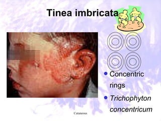 41. laboratory diagnosis of common fungal diseases | PPT