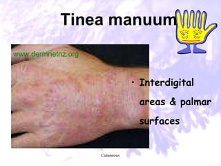 41. laboratory diagnosis of common fungal diseases | PPT