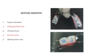 Fabrication of removable partial dentures | PPTX