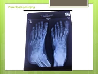 410670591-Ppt-Closed-Fraktur-digiti-III-Pedis-sinistra.pptx