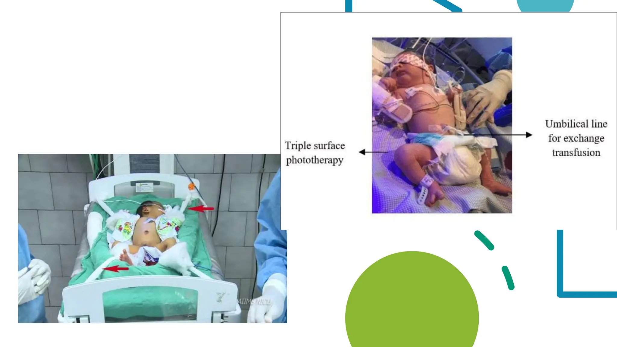 blood transfusion in newborn | PPTX