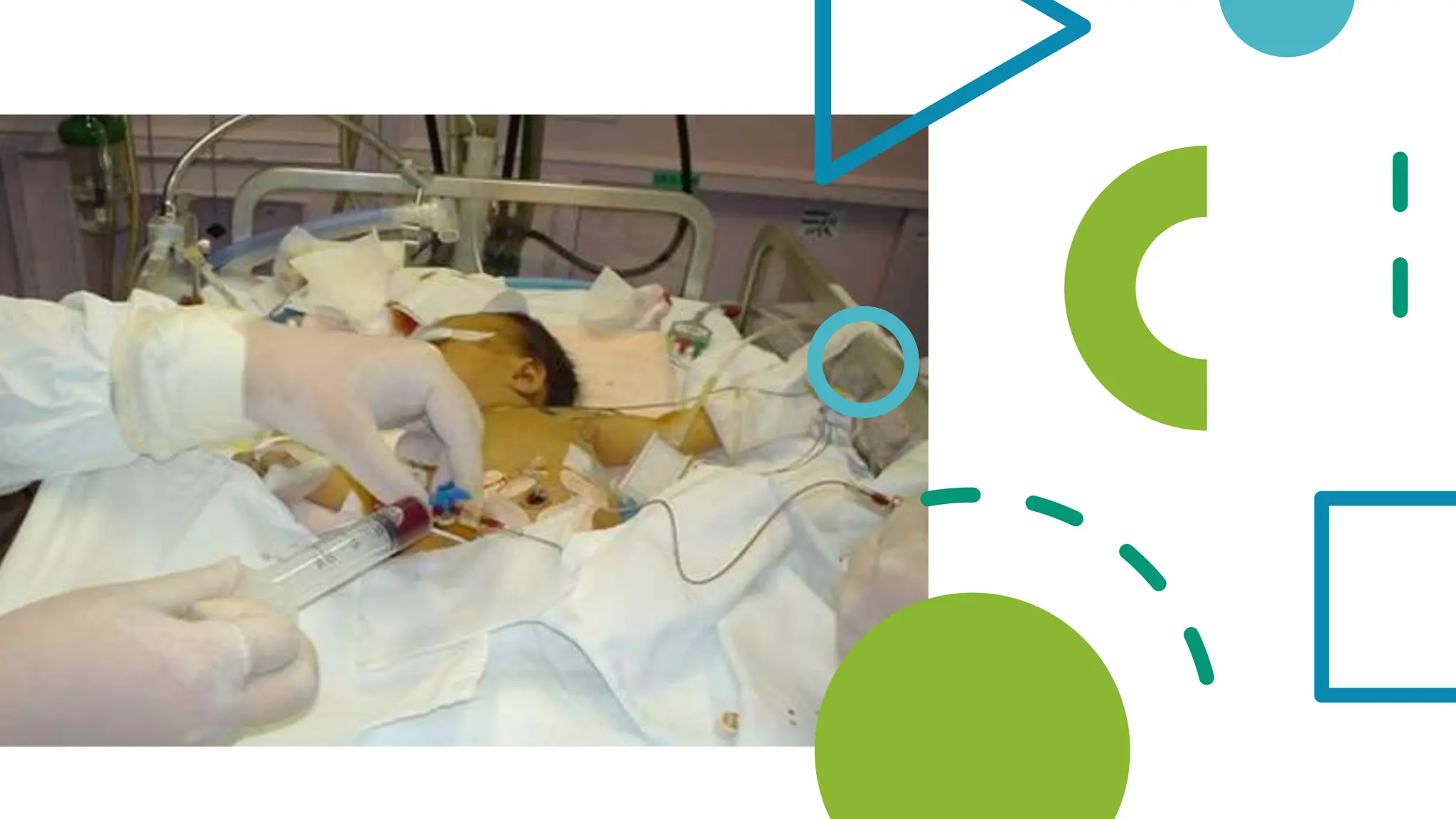 blood transfusion in newborn | PPTX