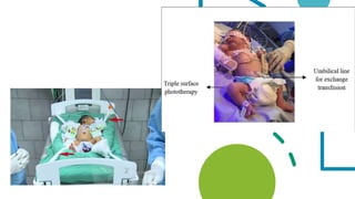 blood transfusion in newborn | PPTX
