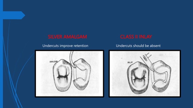 Differences-Between-Cast-Restoration-and-Amalgam[1].pptx