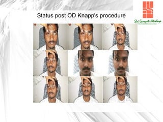 Monocular Elevation Deficit With Pellucid Marginal Degeneration: A Case ...