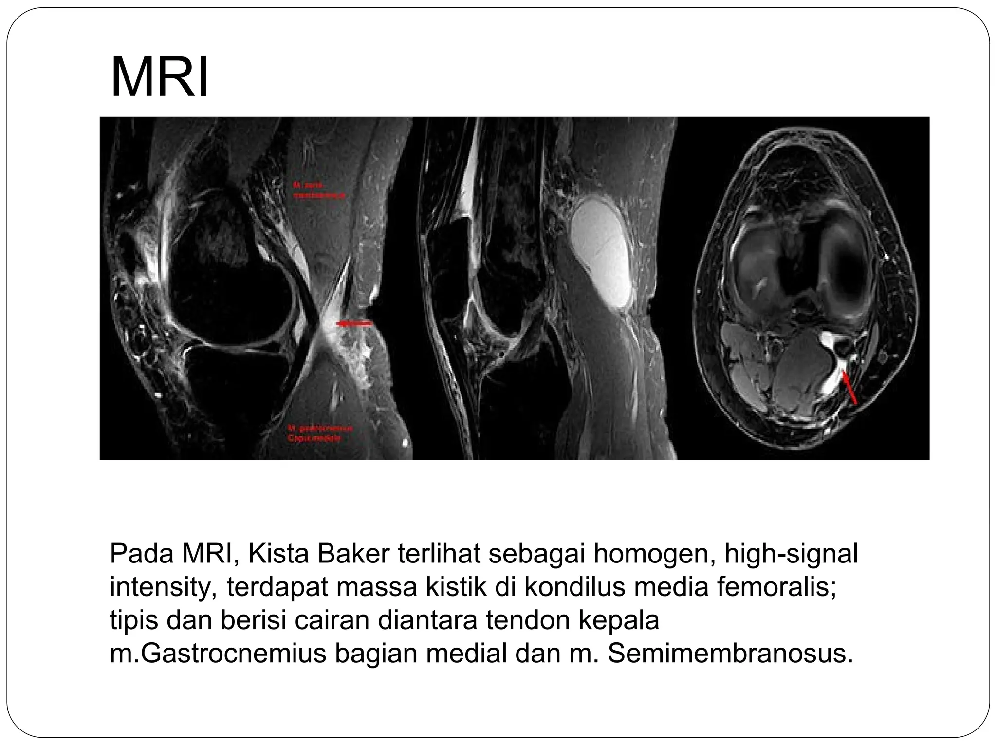 414563162-Baker-Cystaaaaa-Powerpoint.ppt