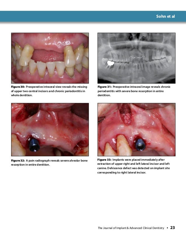 2015 Dec JIACD_Sticky Bone_Sohn et al