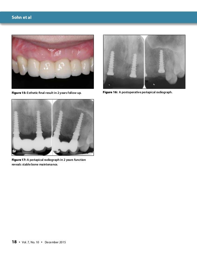 2015 Dec JIACD_Sticky Bone_Sohn et al
