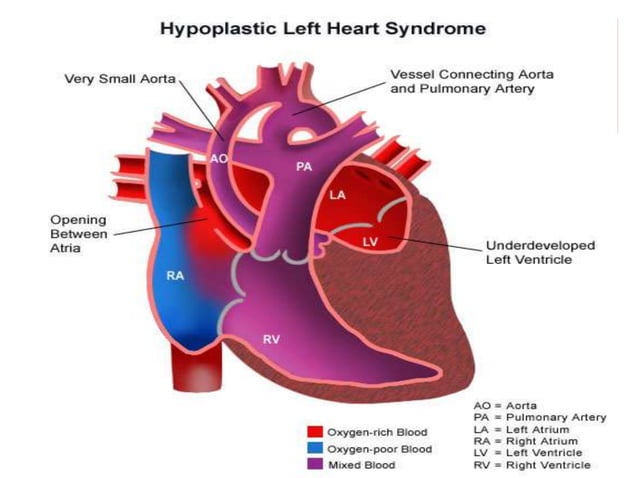 Left Ventricular Outflow Tract Obstruction