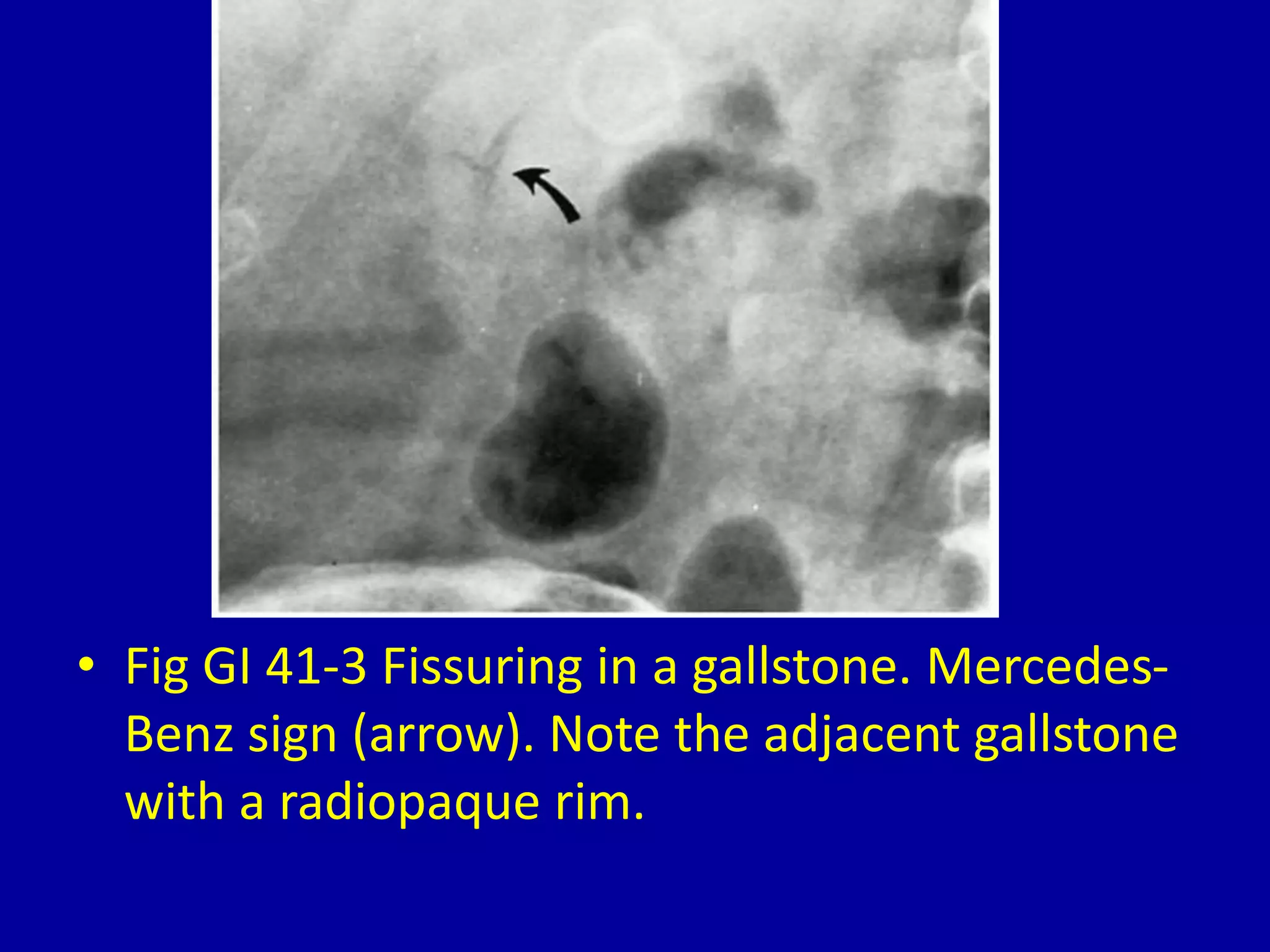 41 filling defects in an opacified gallbladder | PPTX | Digestive ...