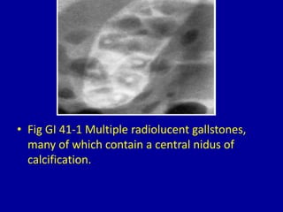 41 filling defects in an opacified gallbladder | PPTX | Digestive ...