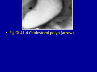 41 filling defects in an opacified gallbladder | PPTX