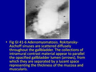 41 filling defects in an opacified gallbladder | PPTX | Digestive ...