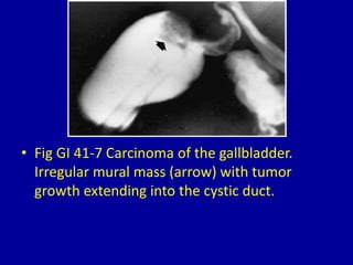 41 filling defects in an opacified gallbladder | PPTX