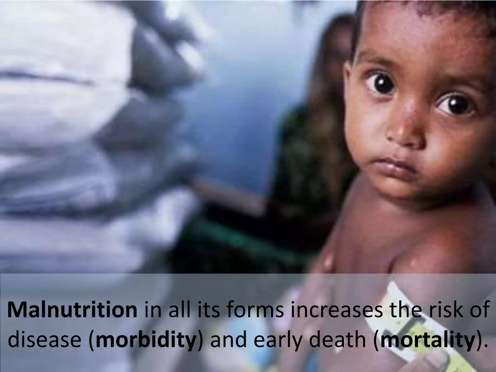 MALNUTRITION | PPTX