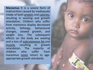 MALNUTRITION | PPTX | Agriculture | Industries