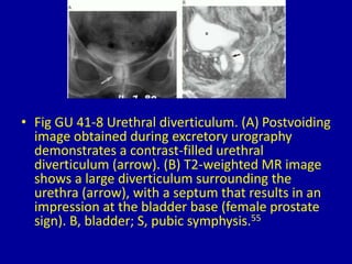 41 urethral disease | PPTX