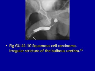 41 urethral disease | PPTX
