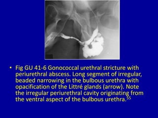 41 urethral disease | PPTX