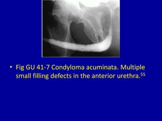 41 urethral disease | PPTX