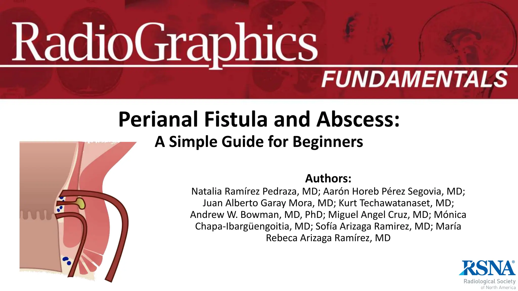 Perianal fistula and Abscess.pptx