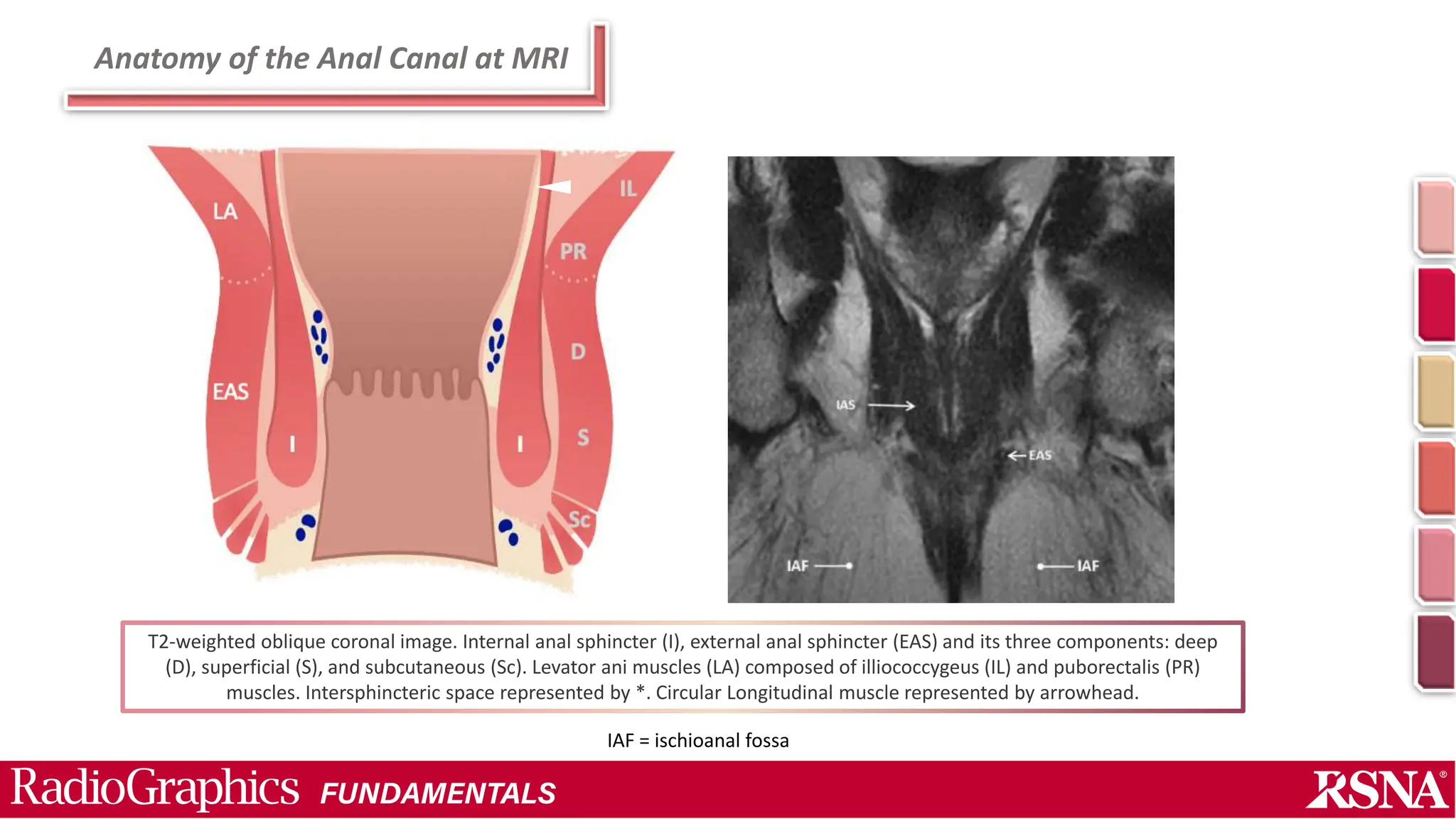 Perianal fistula and Abscess.pptx