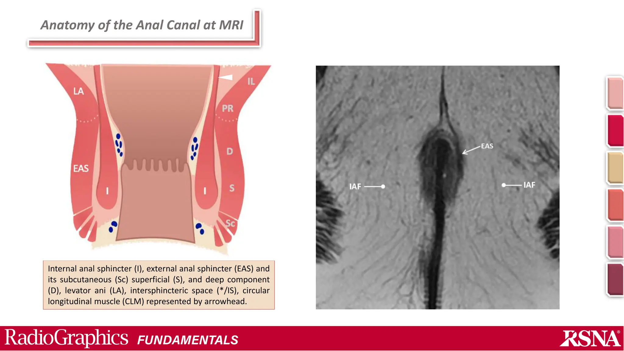 Perianal fistula and Abscess.pptx