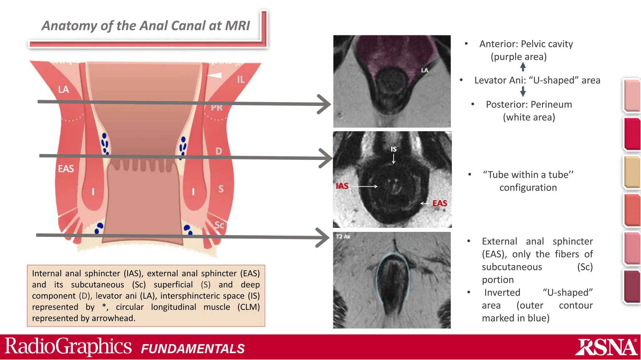 Perianal fistula and Abscess.pptx