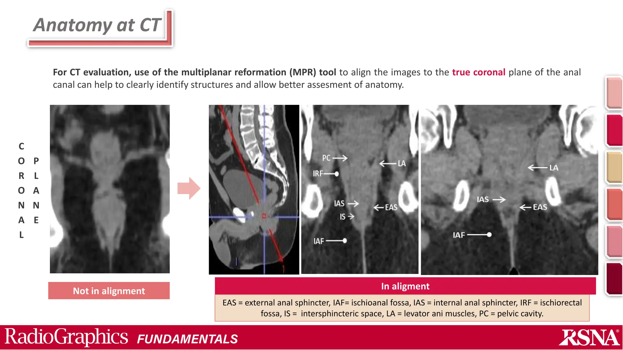 Perianal fistula and Abscess.pptx