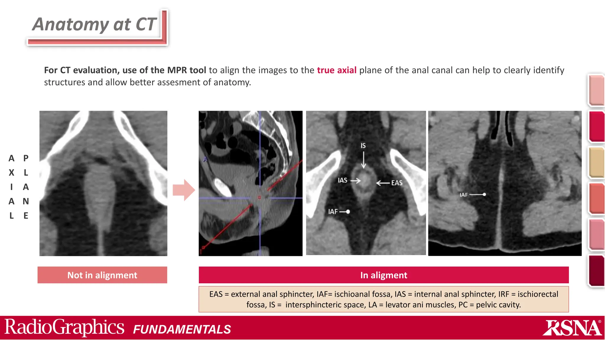 Perianal fistula and Abscess.pptx