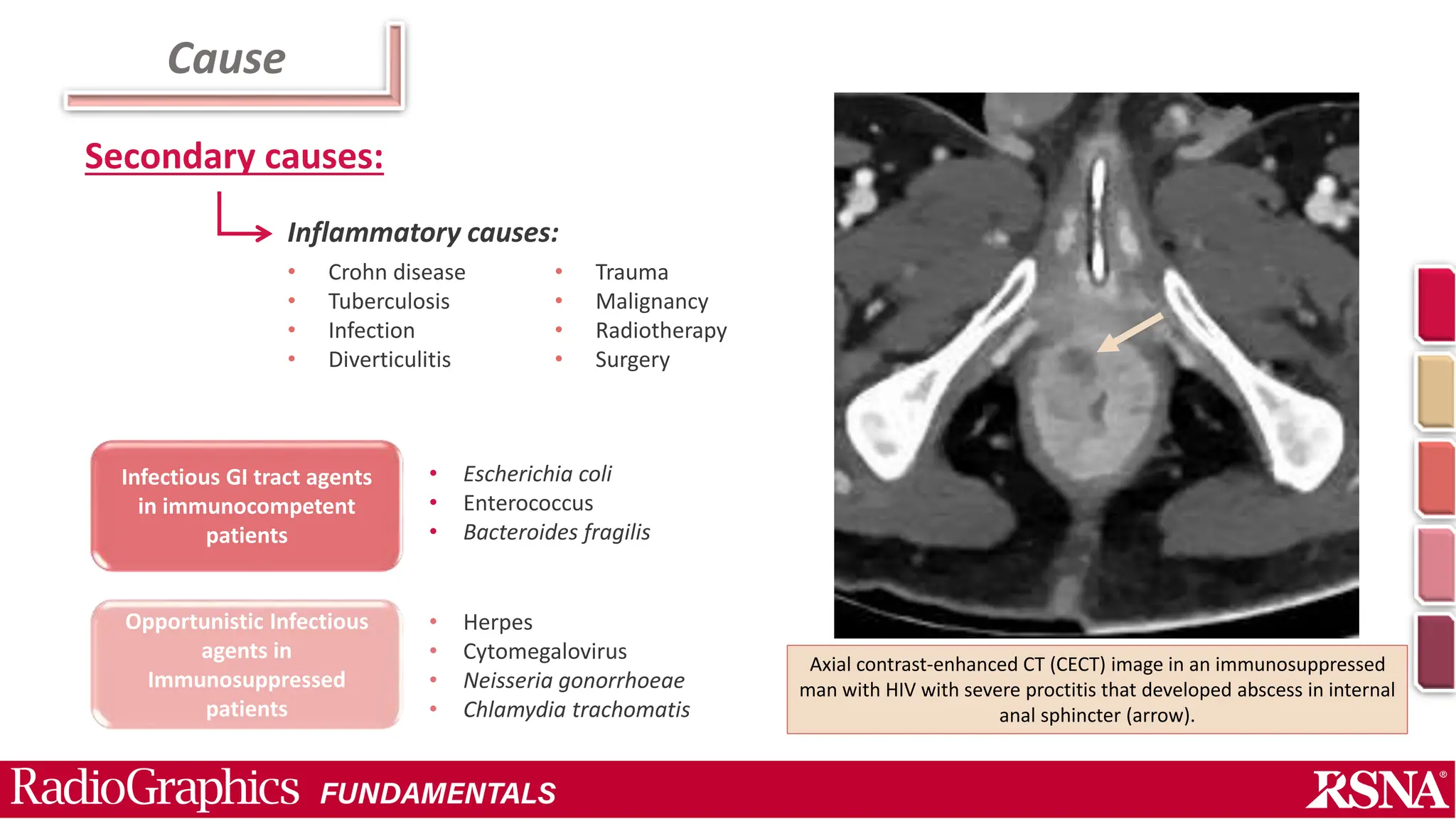 Perianal fistula and Abscess.pptx