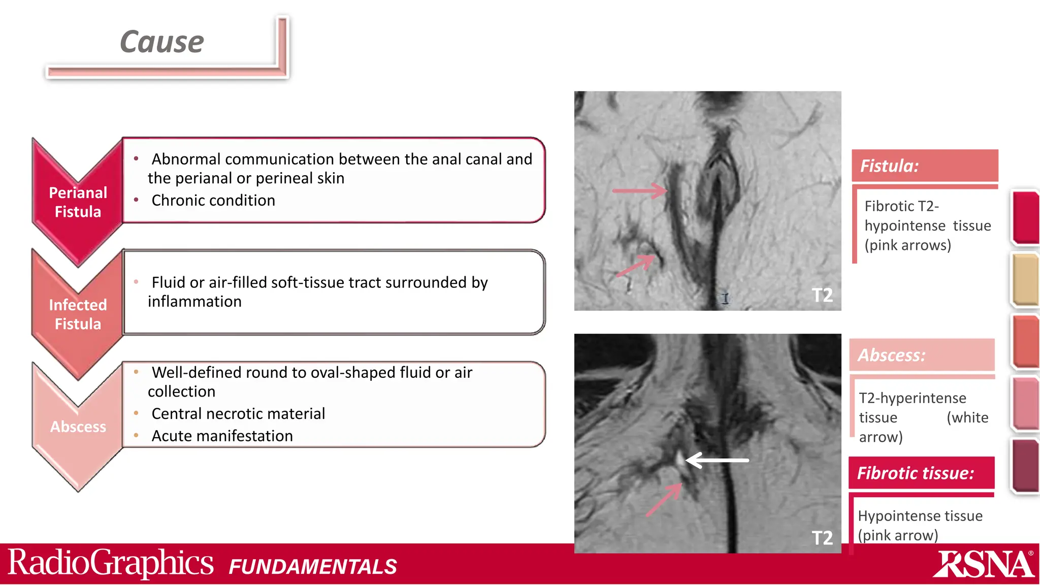 Perianal fistula and Abscess.pptx