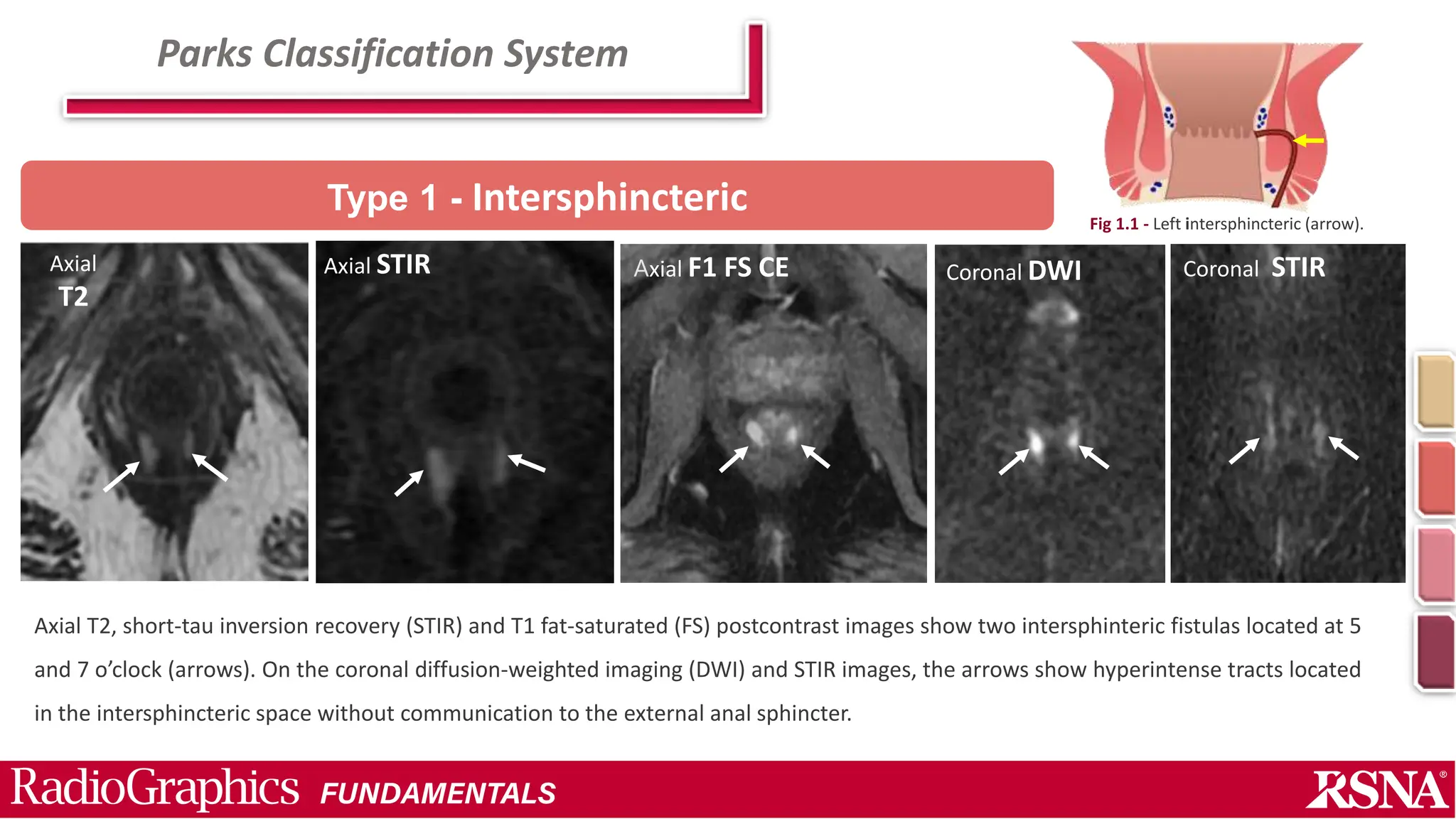 Perianal fistula and Abscess.pptx