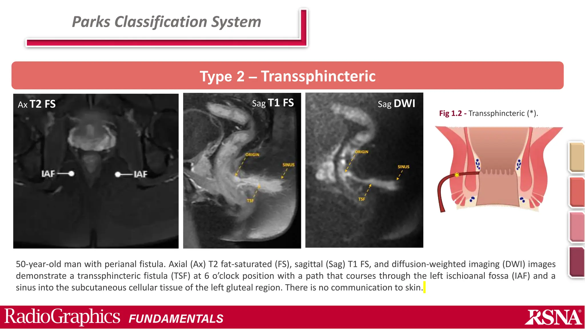 Perianal fistula and Abscess.pptx