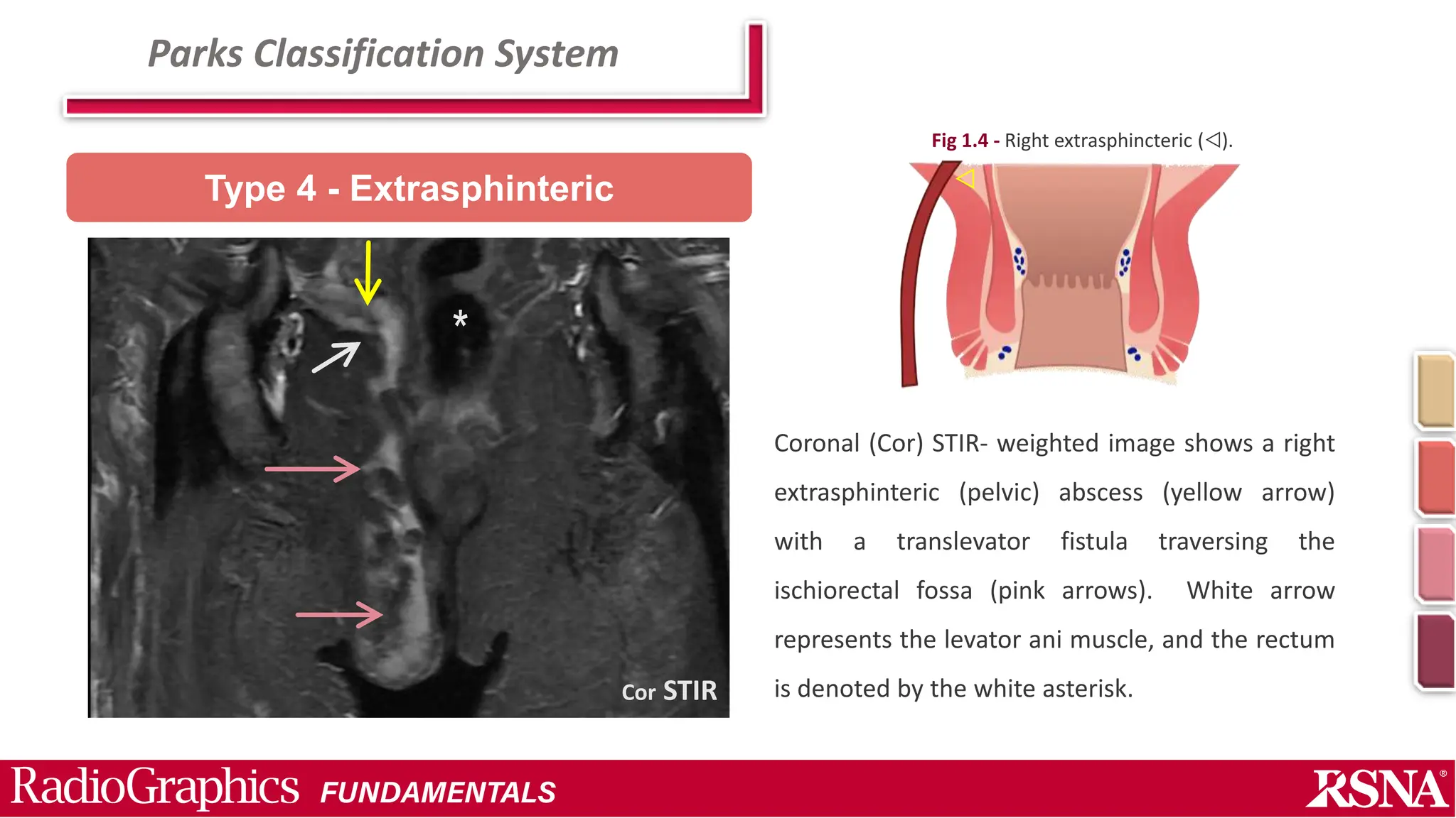 Perianal fistula and Abscess.pptx