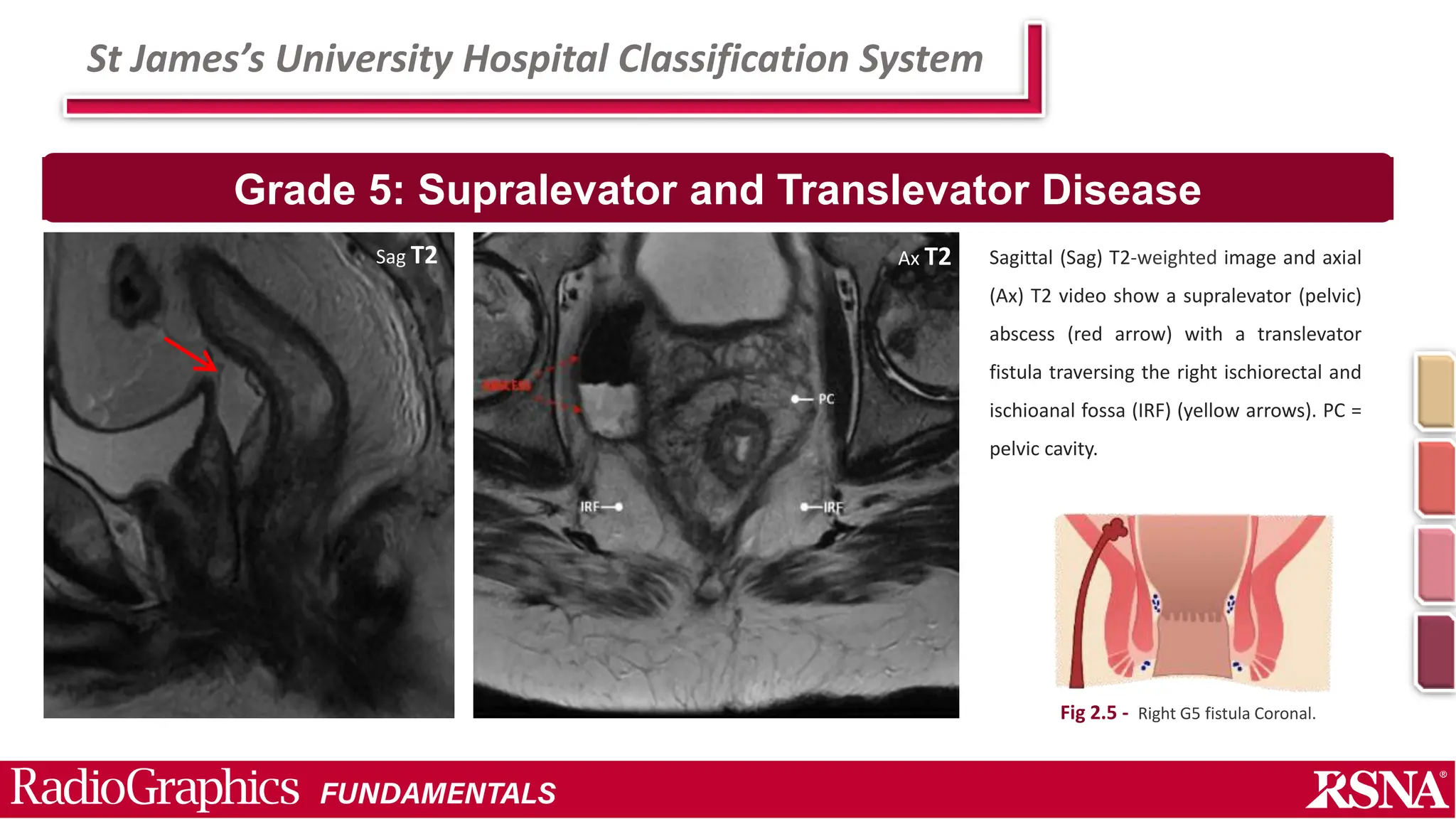 Perianal fistula and Abscess.pptx
