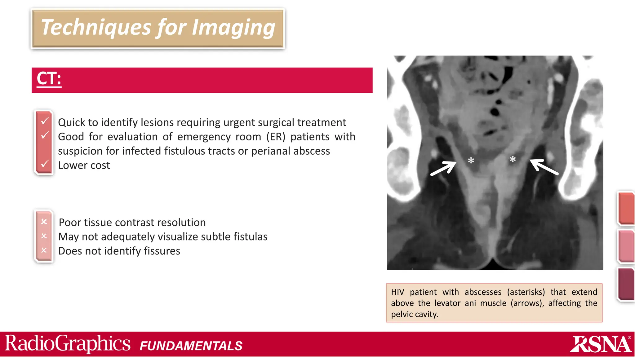Perianal fistula and Abscess.pptx