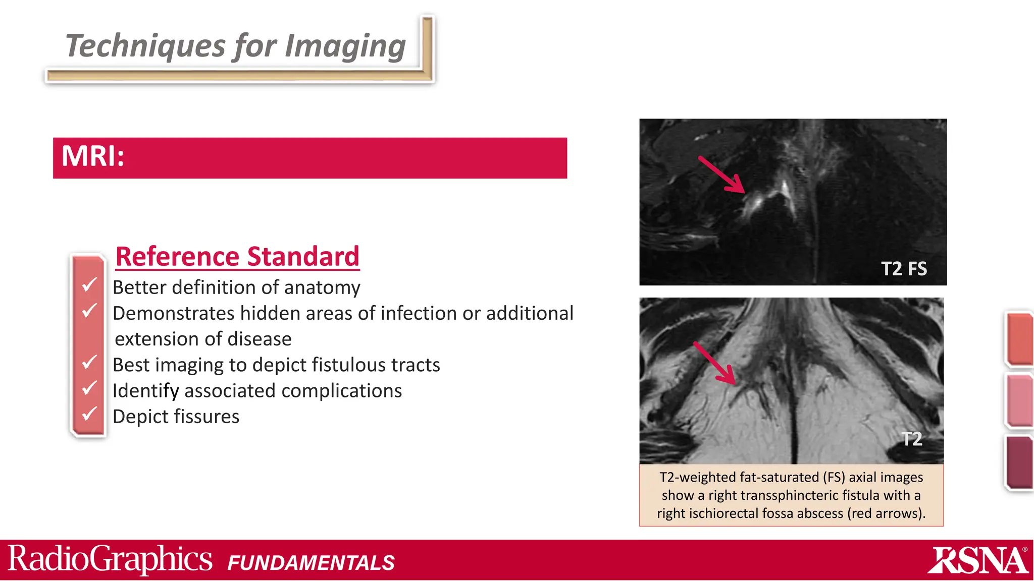 Perianal fistula and Abscess.pptx